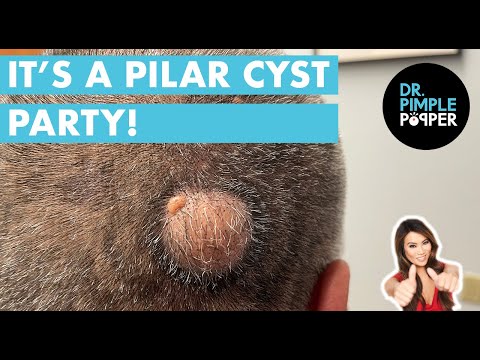 Dr. Pimple Popper Pops 5 Pilar Cysts In Popping Party Youtube Video
