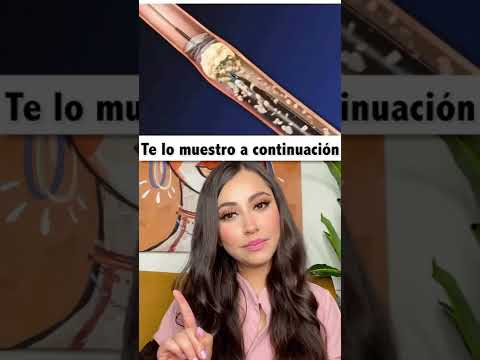 ¿Cómo se remueven las piedras en los riñones?👩🏻⚕️ #shorts #medicina #salud
