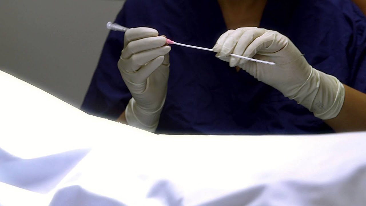 Embryo Transfer at CREATE Fertility