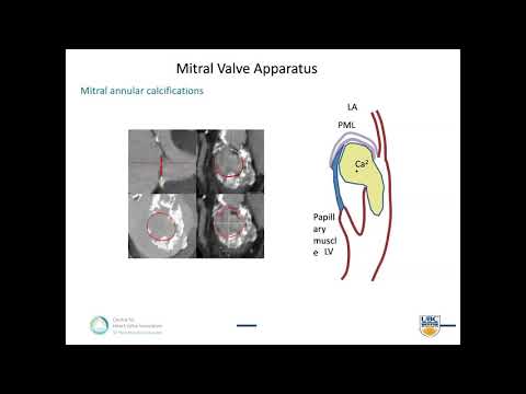 Sponsored Symposium | Advanced CT applications for structural heart disease interventions
