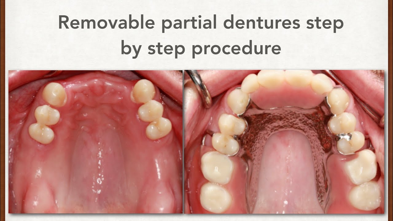 A Comprehensive Guide to the Step-by-Step Procedure for Removable ...