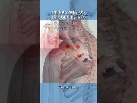 Are Infraspinatus Trigger Points Causing Your Shoulder Pain?
