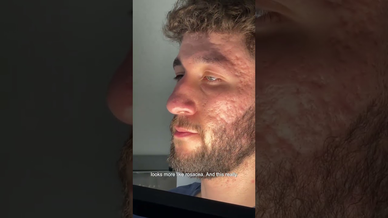 Treating Boxcar & Rolling Scars with TCA Cross & Subcision