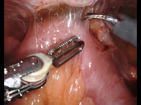 Emergency Robotic Ventral hernia and severe Lysis of adhesions