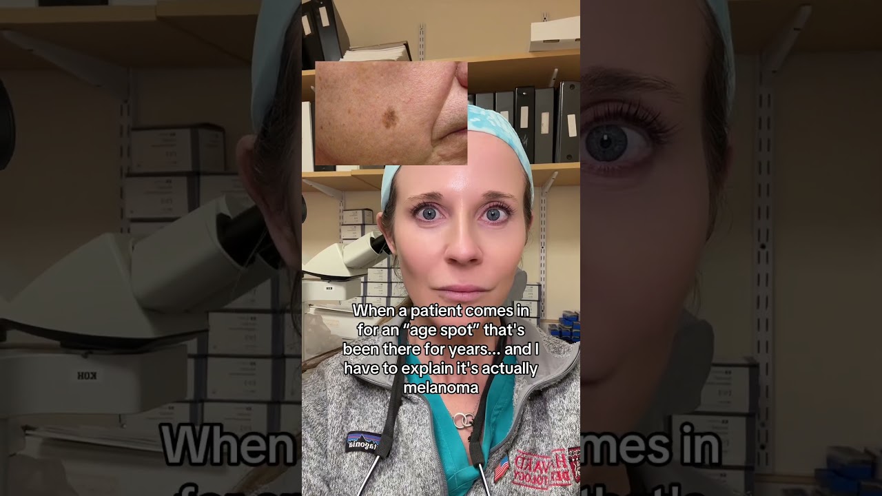 Many people are surprised to learn that this is what most melanomas look like 😬 #melanoma #shorts