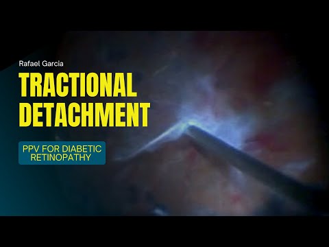 Tractional Retinal Detachment
