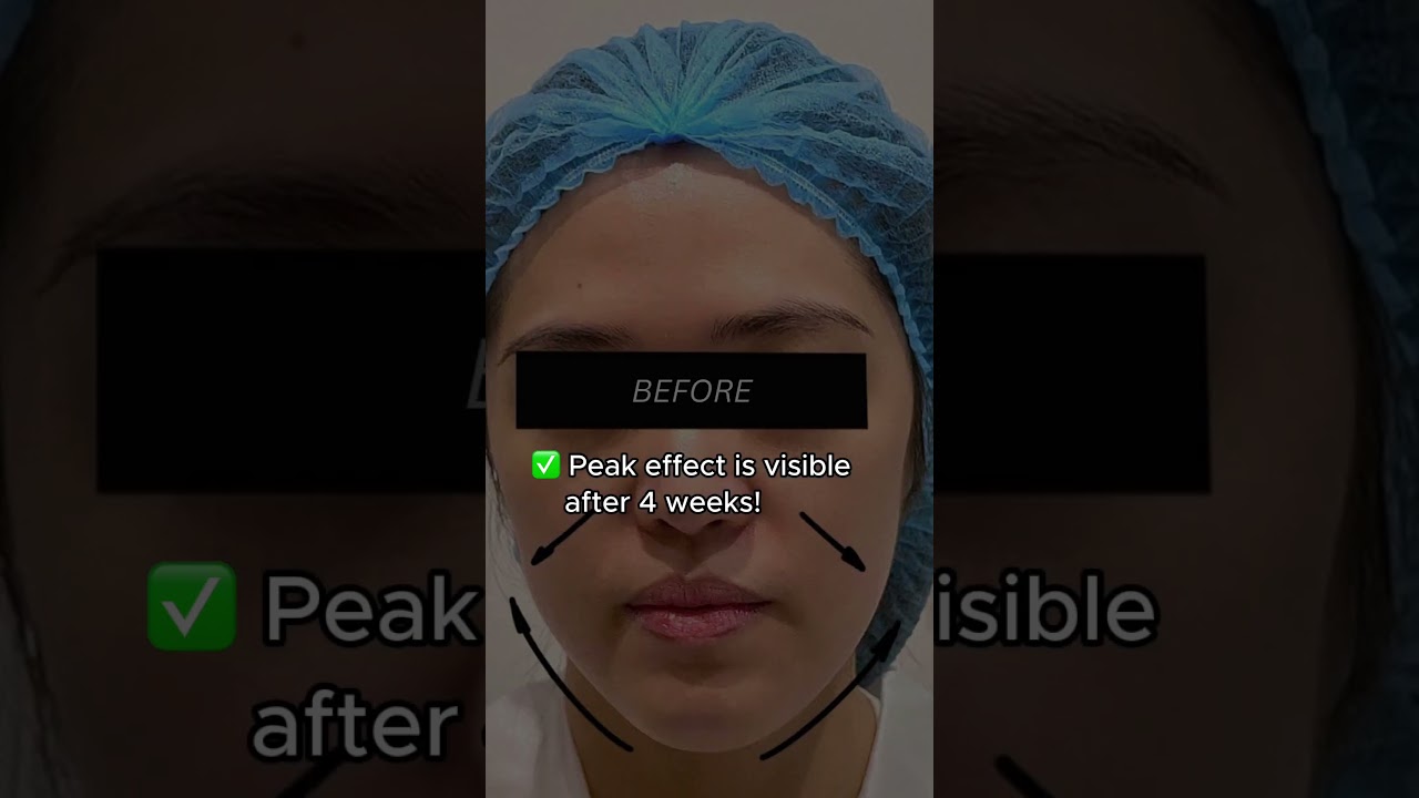 Skin Manila Ultraformer 3 #ultraformeriii #ultraformer3