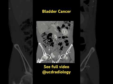 Bladder cancer. #medicine #cancer #bladder #urology #radiology #anatomy #doctor #medicalschool