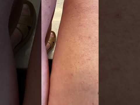 My annoying fasciculations of the day, right thigh