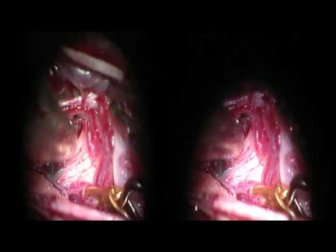 Multimodal Treatment of Spinal Arteriovenous Malformation