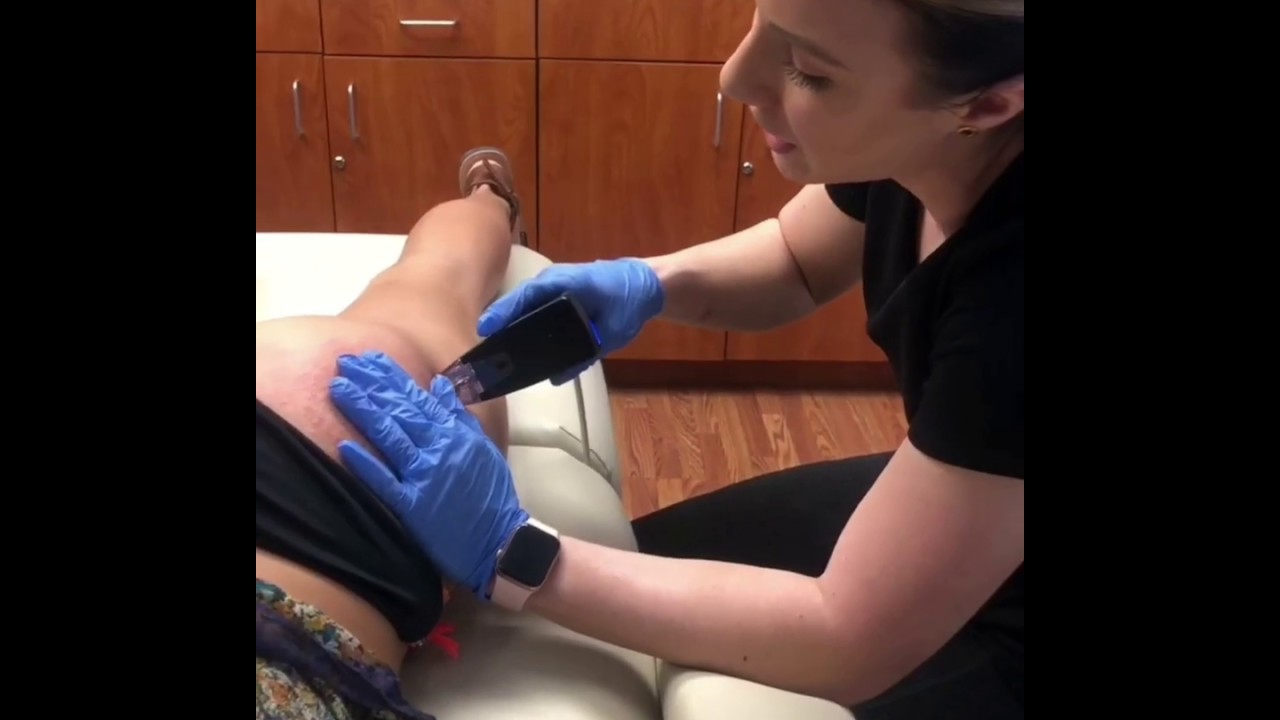 Treat stretch marks with Morpheus8 | Austin Oculofacial Plastics