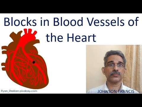 Blocks in Blood Vessels of the Heart
