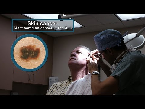 Mayo Clinic Minute: 3 Types of skin cancer