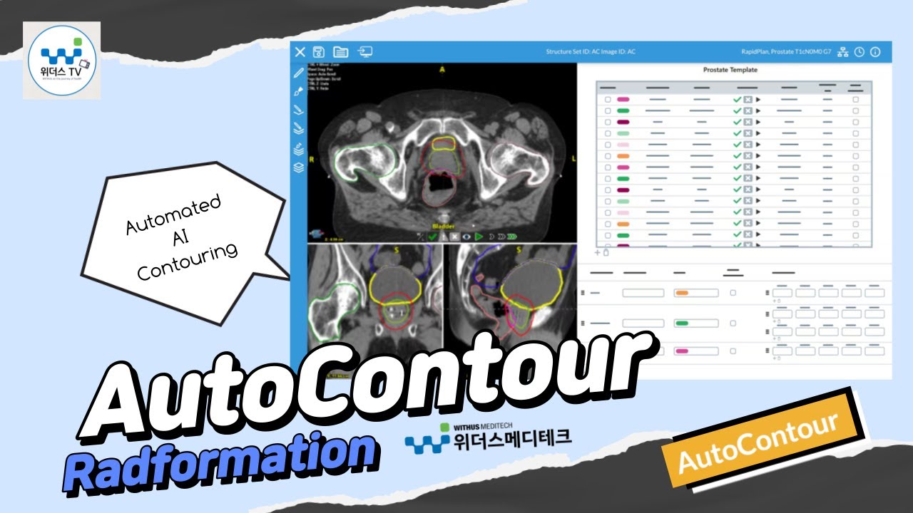 RadformationㅣIntroducing AutoContour: Automated AI Contouring Software