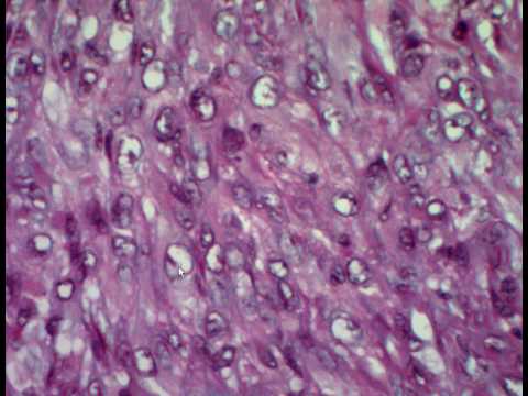 Epithelioid Sarcoma - Pathology - Orthobullets