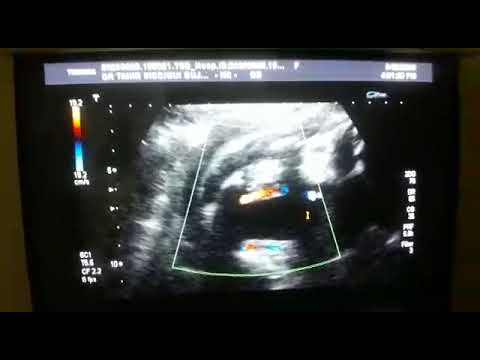 32 WKS GA with BILATERAL OBSTRUCTIVE UROPATHY and oligohydramnios