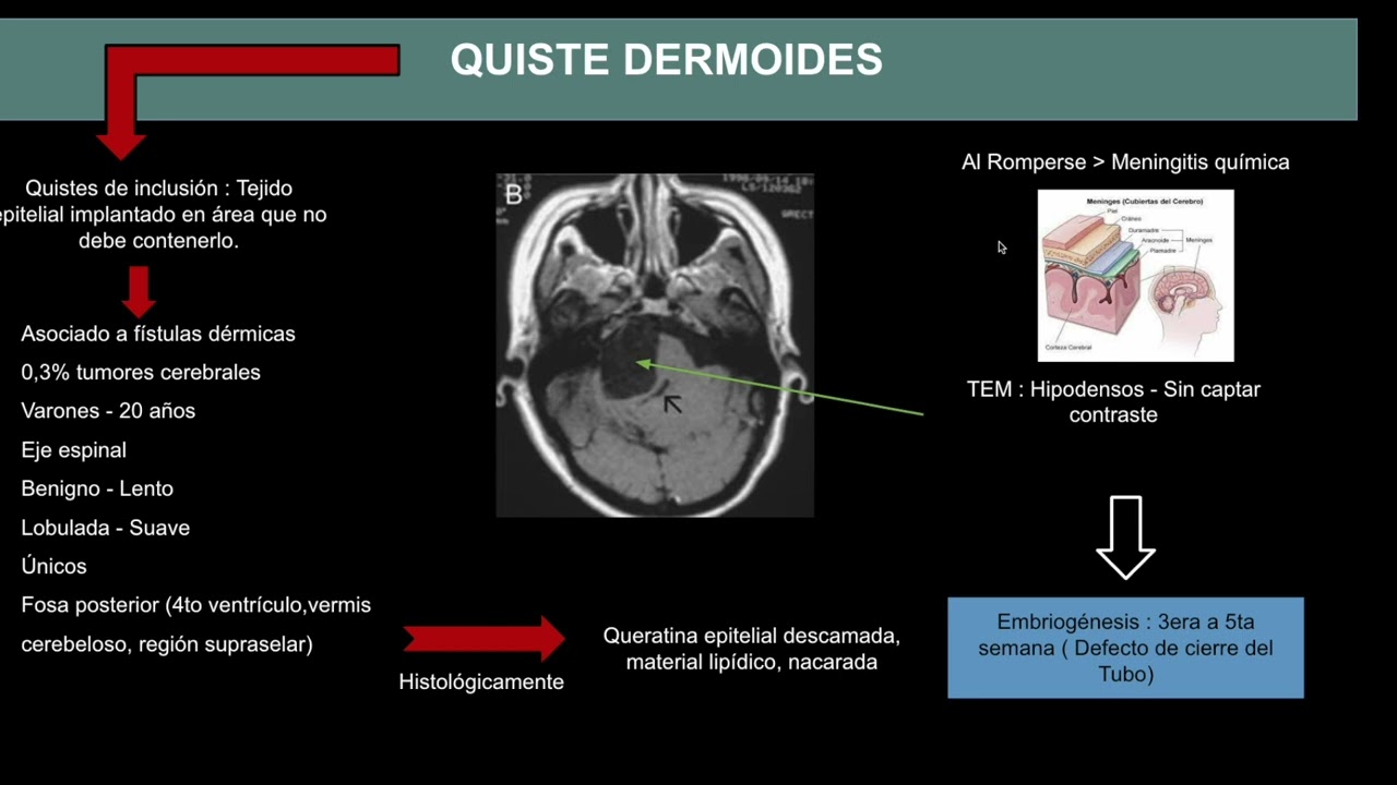 QUISTES DERMOIDES