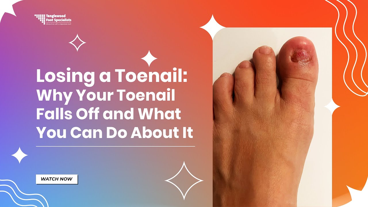 Losing a Toenail: Why Your Toenail Falls Off and What You Can Do About It