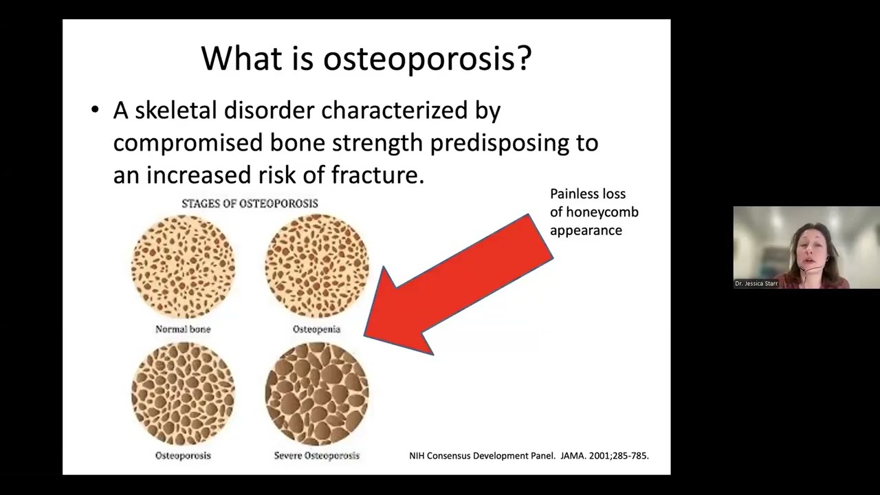 Lupus and Bone Health: Understanding the Connection (HSS)