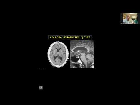 Imaging of Colloid Cysts, Thomas P. Naidich, MD