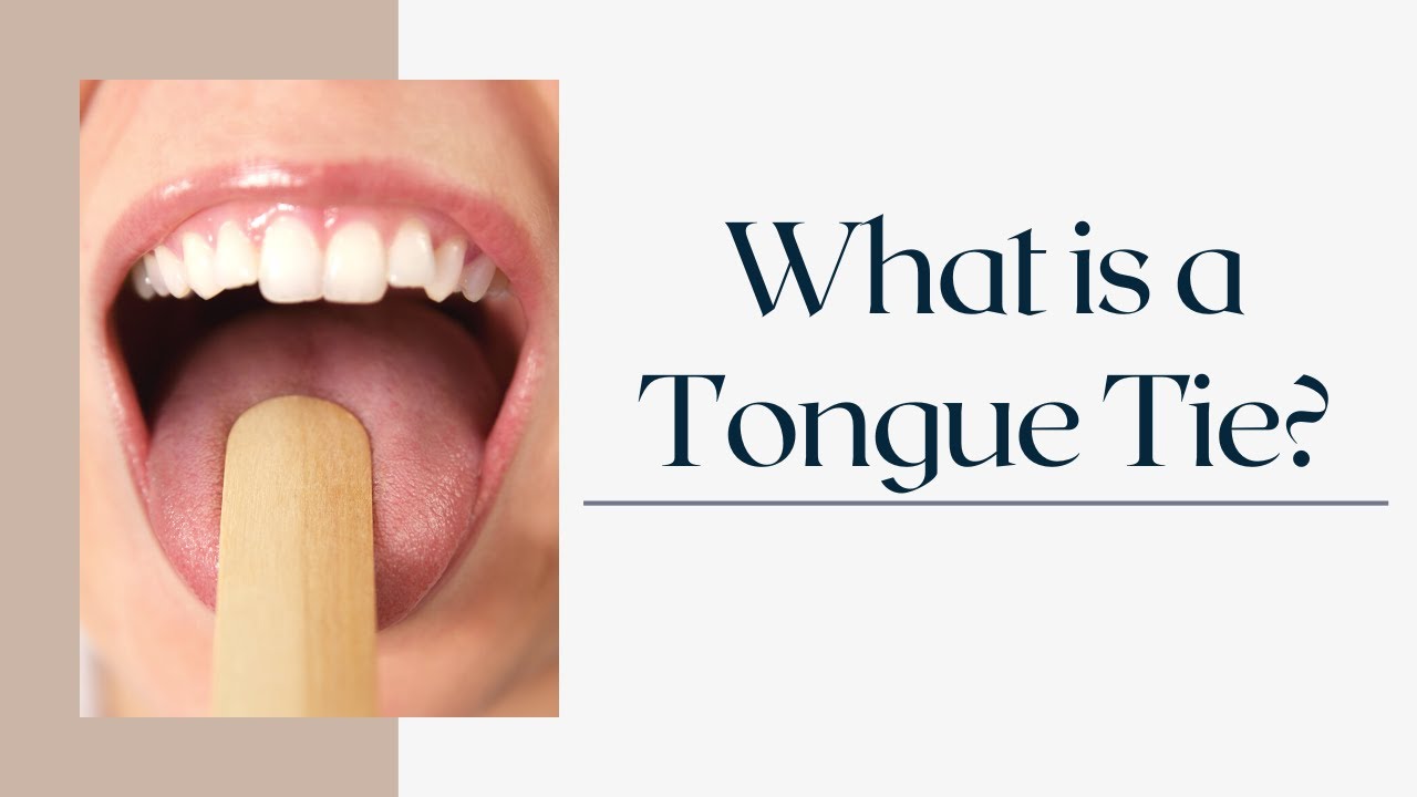 What is a Tongue Tie?