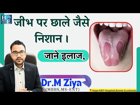 Geographical Tongue. Migratory Glossitis. Oral Ulcer. Tongue Ulce. मुंह के छाले।