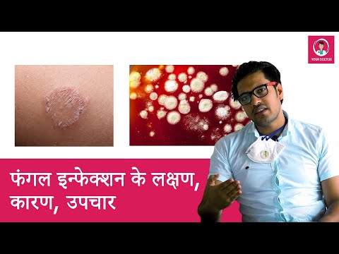 Fungal Infection Causes In Hindi | फंगल इन्फेक्शन ( दाद ) के कारण | Your Doctor | Dr. Rajesh Narbar