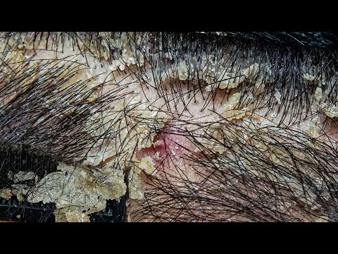 Dandruff scratching removal on head using black combing #DKMO3345
