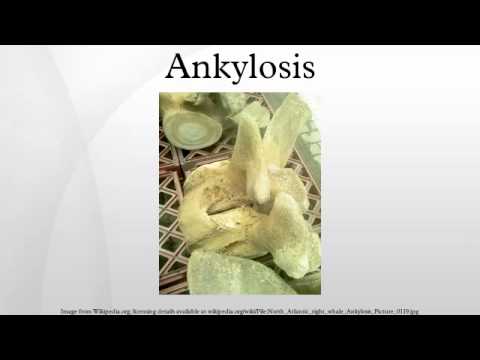 Ankylosis