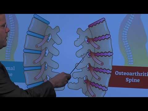 Anatomy of Spine: Osteoarthritis