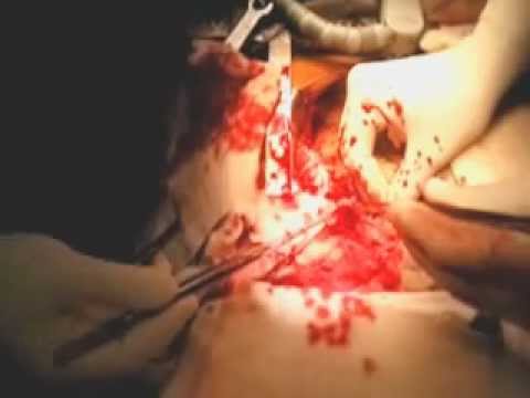 Left Internal Mammary Artery Flow