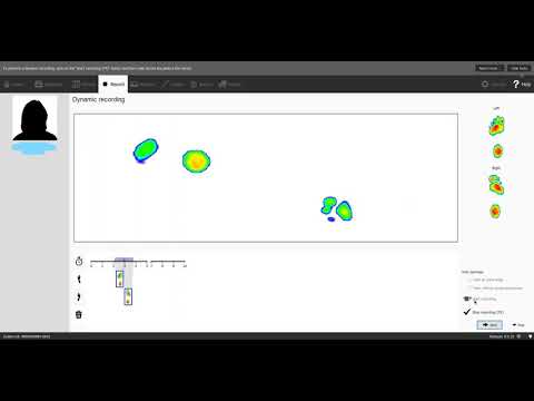 Custom Orthotics Gait Analysis