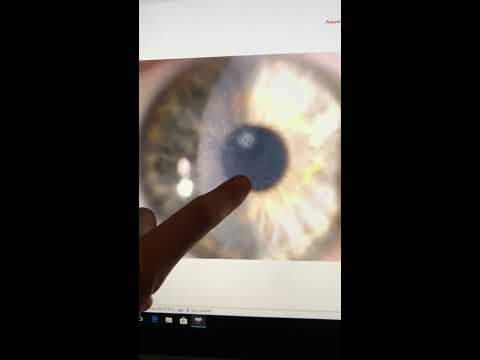 Reid-Bucklers Corneal Dystrophy, Kanellopoulos MD