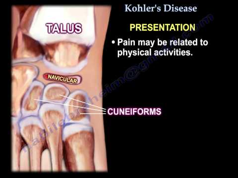 Kohler's Disease - Everything You Need To Know - Dr. Nabil Ebraheim