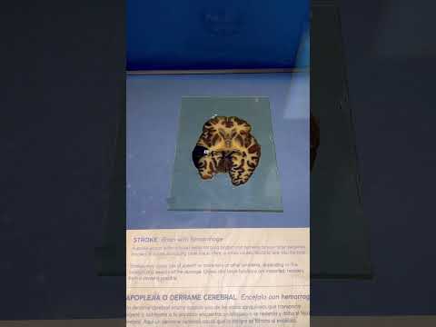 Stroke #stroke #cva #brainattack #anatomy #brain #nurse #nursing #nursingstudent #medical #shorts