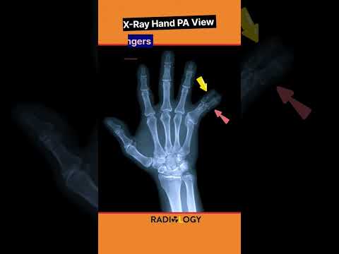 Six Fingers in Hand X-ray âš¡ Extra Little Finger #shorts #xray