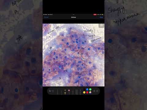 3 points to easily diagnose a case of Bacterial Vaginosis-Pap smear cytology #papsmear #pathology