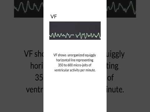 Ventricular fibrillation vs Ventricular tachycardia