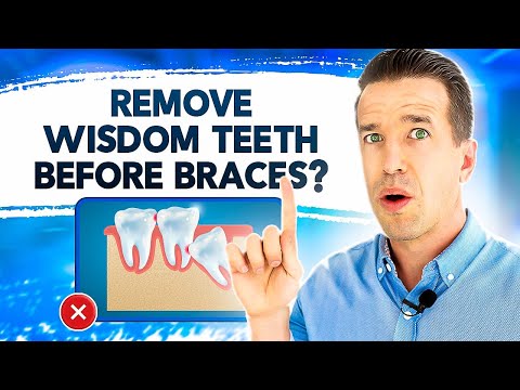 Do Wisdom Teeth Make Your Teeth Crooked?