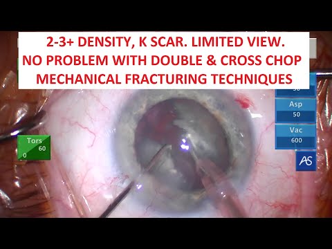 TBWTDCS #180: 2-3+ DENSITY, K SCAR. NO PROBLEM WITH DOUBLE & CROSS CHOP. MECHANICAL FRACTURIN