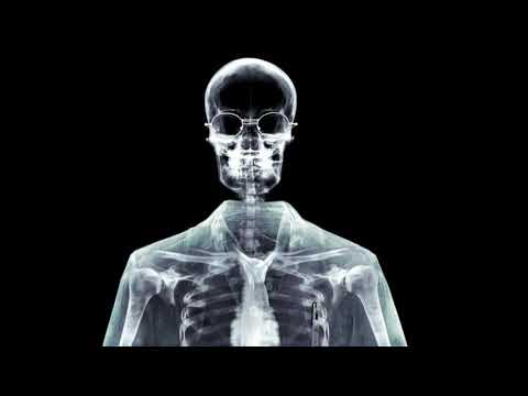 What is a bone density scan DEXA?