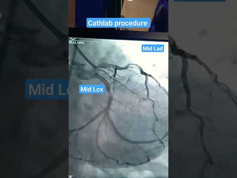 Cathlab procedure 💯 ❣️❤️Mid Lad & ❣️Mid Lcx dseased#shortvideo #cathlab #doctor #dream #motivation
