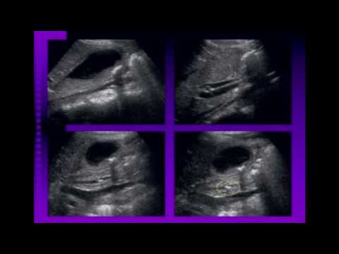 Biliary and Pancreatic Abnormalities on Ultrasound