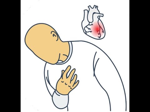 ACS (Acute Coronary Syndrome) Update_Dr Pradeep Rangappa