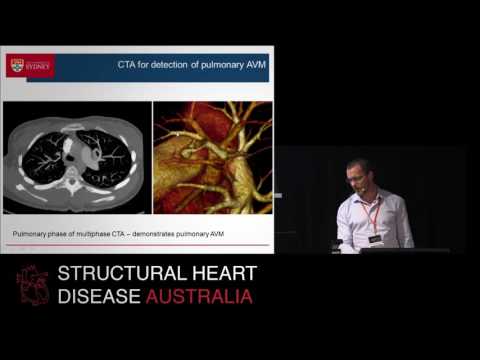 What MRI and CT now reveal about the left atrium – Prof Stuart Grieve