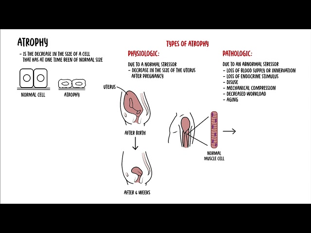 Understanding Cellular Adaptation: Hyperplasia, Hypertrophy, Atrophy ...