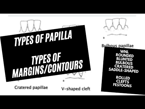 Types of papilla and types of margins/contours