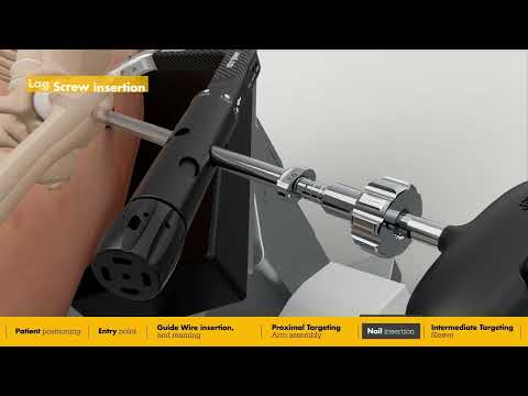 Intermediate Nail surgical animation | Gamma4 Hip Fracture Nailing System