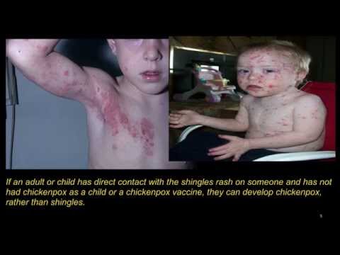 Shingles