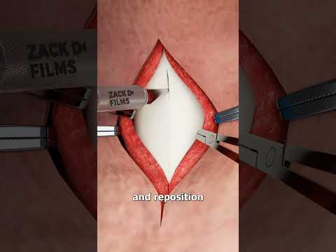 What Happens During A Tracheotomy ????